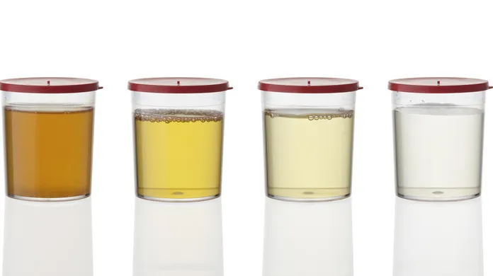 Saiba quando a cor do xixi pode indicar problemas de saúde